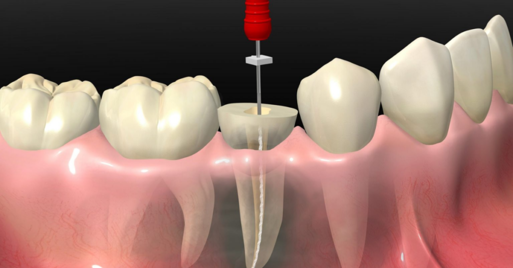 Root Canal Delays: Risks and Consequences Explained